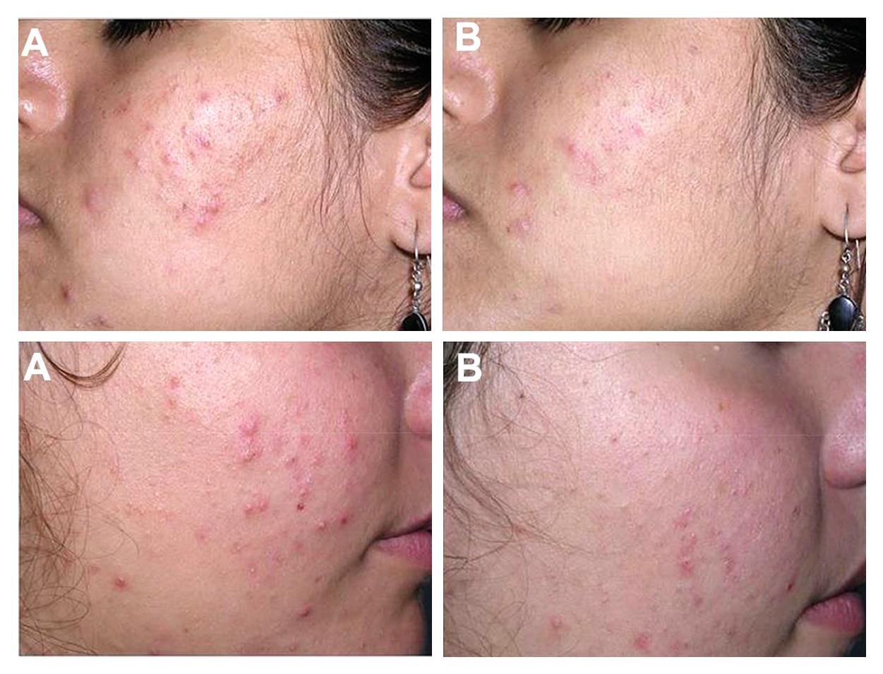 Review trải nghiệm “siêu phẩm” trị mụn Urgo Acneum